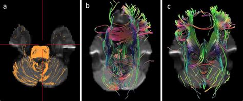 Initial Dti Tractography A Visual Representation Of Corticospinal