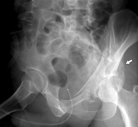 Classification Of Common Acetabular Fractures Radiographic And Ct