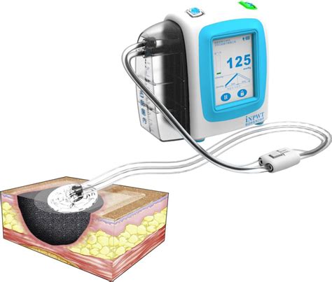 Wound Care Vacuum Pump At Jamie Gibb Blog