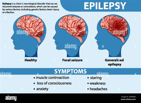 Informative Poster Of Epilepsy Illustration Stock Vector Image And Art Alamy