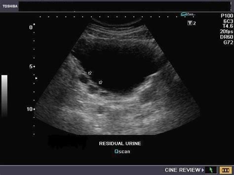 Bladder Trabeculation