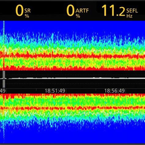Spectrogram Of Propofol Based Anesthesia With Highest Power In The Download Scientific Diagram