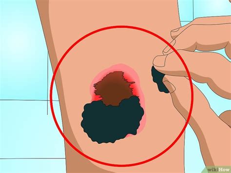 How To Get Rid Of Acne Scabs Fast 10 Effective Ways