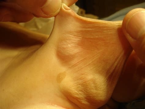 Other Penile Abnormalities Pediatric Urology Book