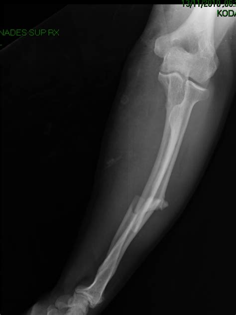 Cirugía De Mano Fractura De Radio Y Cúbito