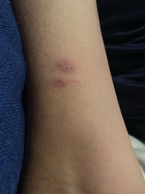 Identify This Bug Bite R Bugbites