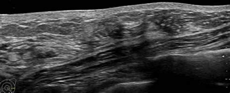 Breast And Axilla 5 2 Malignant Breast Lesions Case 5 2 2 Breast