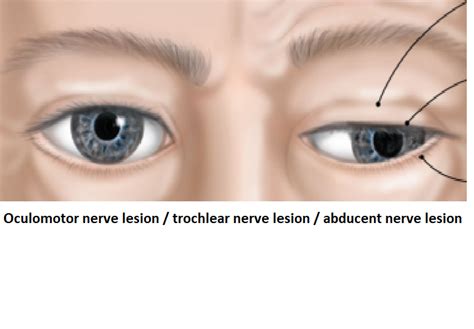Easyhumanatomy How To Identify Lesion Of Nerves Supply Extraocular