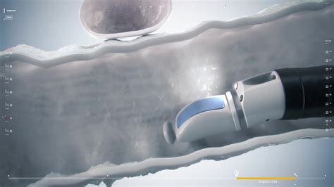 Dor Operation Endoventricular Circular Patch Plasty Department Of