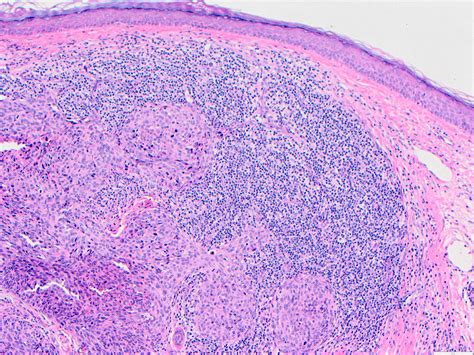 Epithelioid Angiosarcoma