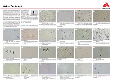 M2xfzr De Urine Crystals Urine Sediment Calcium Oxalate Crystals
