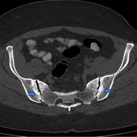 Axial Ct Scan Showing Sclerosis Of Iliac Bones Arrows Adjacent To