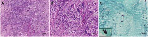 Histopathological Features Of Oral Paracoccidioidomycosis A The Oral