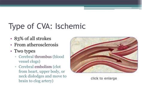 Ppt Cerebrovascular Accident Stroke Powerpoint Presentation Id