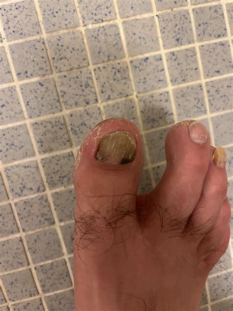 Does It Look Like Melanoma Rmelanoma