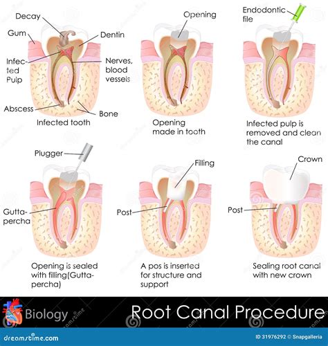 Root Canal Procedure Stock Vector Illustration Of Endodontic