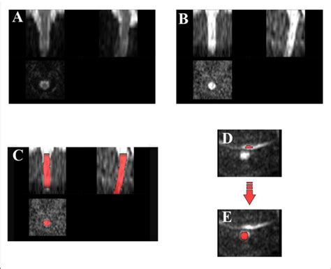 Preprocessing Diffusion Kurtosis Imaging Scan Through Preprocessing