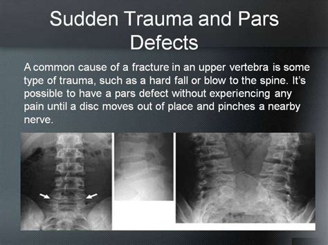 Understanding The Causes Of Pars Defects