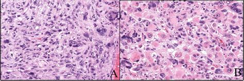 Müllerian Adenosarcoma With Sarcomatous Overgrowth And Heterologous Elements A Case Report And