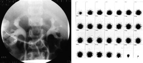 Left Pre Operative Voiding Cystourethrogram Of A Patient Showing Download Scientific Diagram