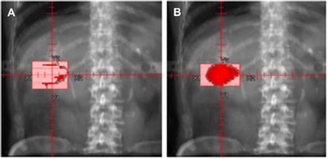 Beam Eye View Of Multi Leaf Collimator Control Point One Control Point Download Scientific