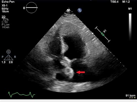 A 25 Mm Amplatzer Pfo Occluder Device Visualized On A Tte Red Arrow Download Scientific