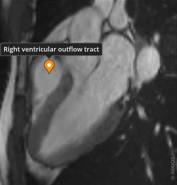 Right Ventricular Outflow Tract E Anatomy Imaios