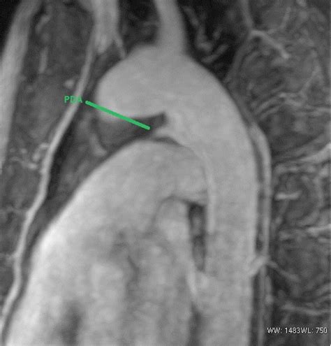 Patent Ductus Arteriosus Cardiac MRI