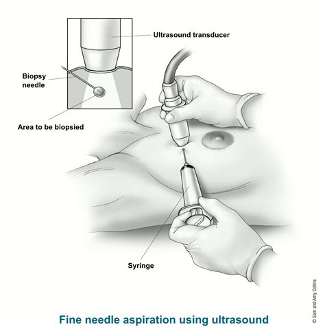 Needle Aspiration Vs Biopsy At Dorothy Hood Blog