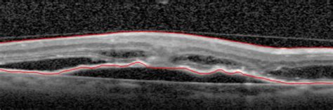 The Retina Is Defined As The Region Between The Inner Limiting Membrane Download Scientific