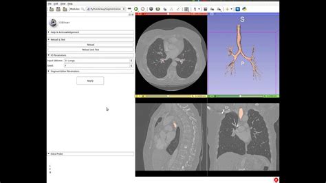 Best Strategy To Integrate Airway Segmentation Into Lungctsegmenter