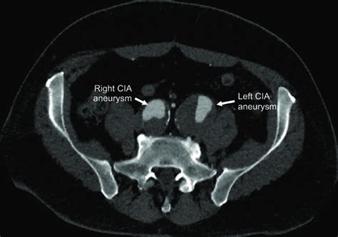 Axial Computed Tomography Slices Where The Common Iliac Artery Cia