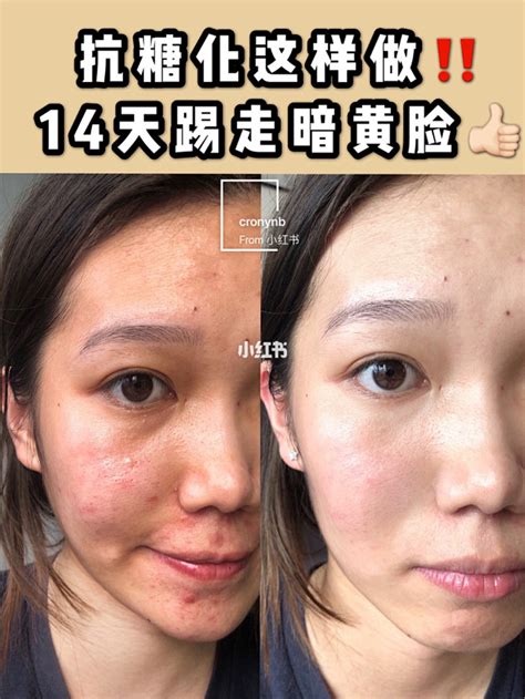 抗糖化这样做改变暗黄脸 我是一个爱吃甜食的平时睡觉也很晚所以皮肤也没有那么好肤色也偏暗黄还容易长痘前阵子皮肤差的想哭朋友叫我也