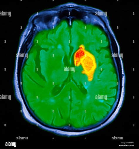 Coloured Magnetic Resonance Imaging Mri Scan And Ct Of An Axial