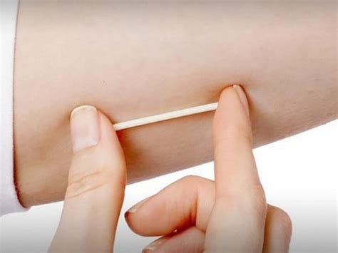 10 TÁc DỤng PhỤ CỦa CẤy Que TrÁnh Thai VÀ CÁch PhÒng TrÁnh Doctor