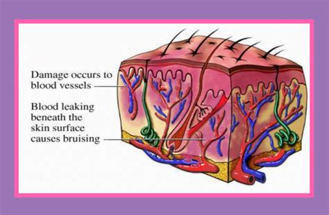 Bruise Easily Dieting May Increase Your Risk For Bruises Unless You Try This Tip Utah Md