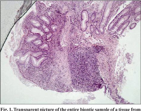 Figure 1 From Morphology Of Intestinal Microcirculation In Colitis Ulcerosa And Crohns Disease
