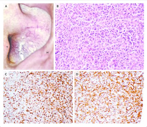 A Subcutaneous Mass In The External Ear On Intraoperative Clinical