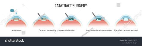 Vectorial Medical Poster Cataract Surgery Stages Stock Vector Royalty