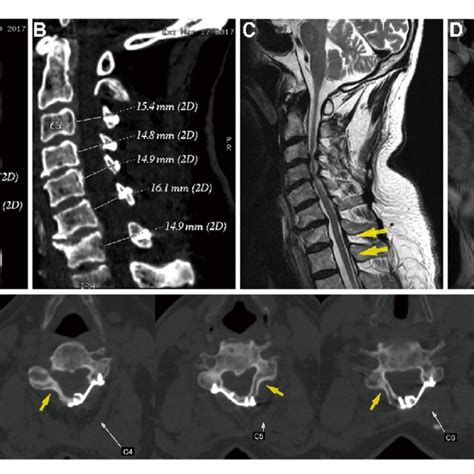 Ab Preoperative And Postoperative Sagittal Ct Scans Illustrating Download Scientific