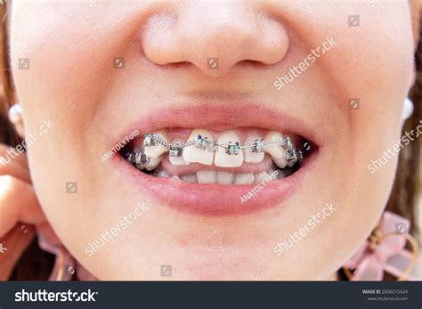 Braces On Ugly Teeth At Beth Anker Blog