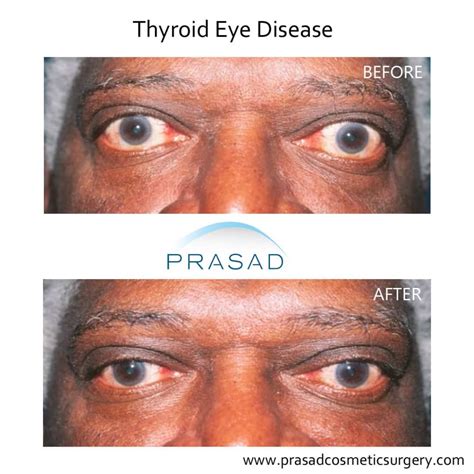 Graves Disease Eyes Treatment