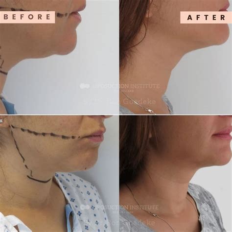 Pin On Chin Reduction Before And Afters