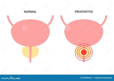 Prostatitis Inflammation Problem Stock Vector Illustration Of Chronic