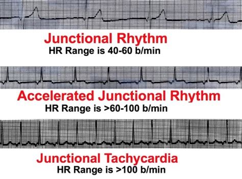 Idioventricular Rhythm Vs Junctional