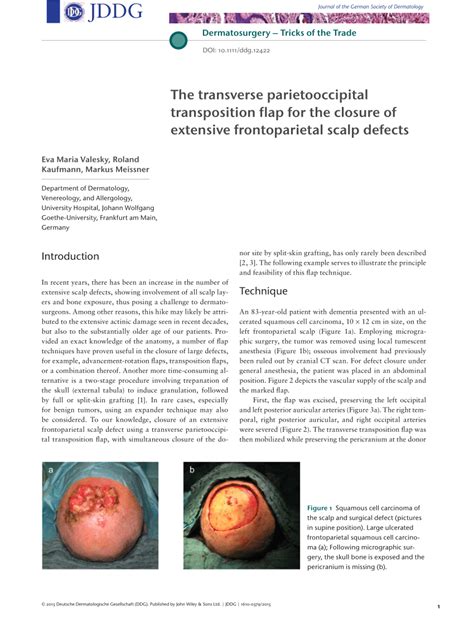 Pdf The Transverse Parietooccipital Transposition Flap For The Closure Of Extensive