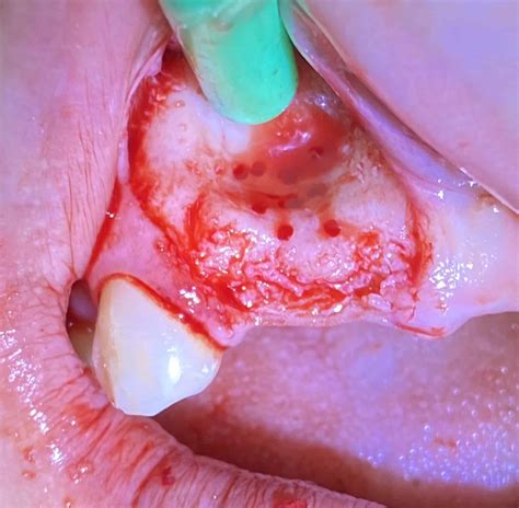 3 Dental Implants In Lower Left Quadrant With Bone Block Graft Case
