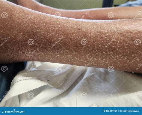 Pembroliimab Rash With Edema And Desquamation Cancer Patient Stock