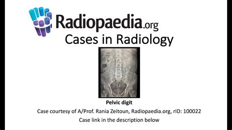 Pelvic Digit Cases In Radiology Youtube