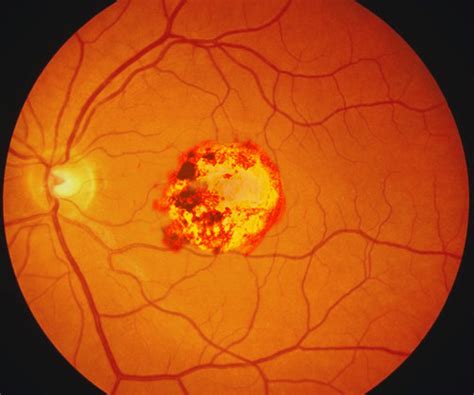 Congenital Toxoplasmosis Md Searchlight